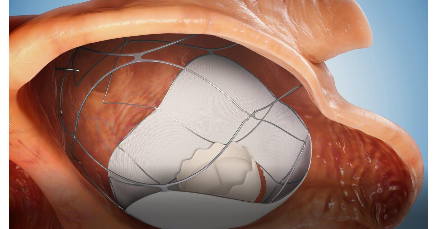 A New Era in Heart Surgery - Israeli Biomed Company TruLeaf Medical's ...
