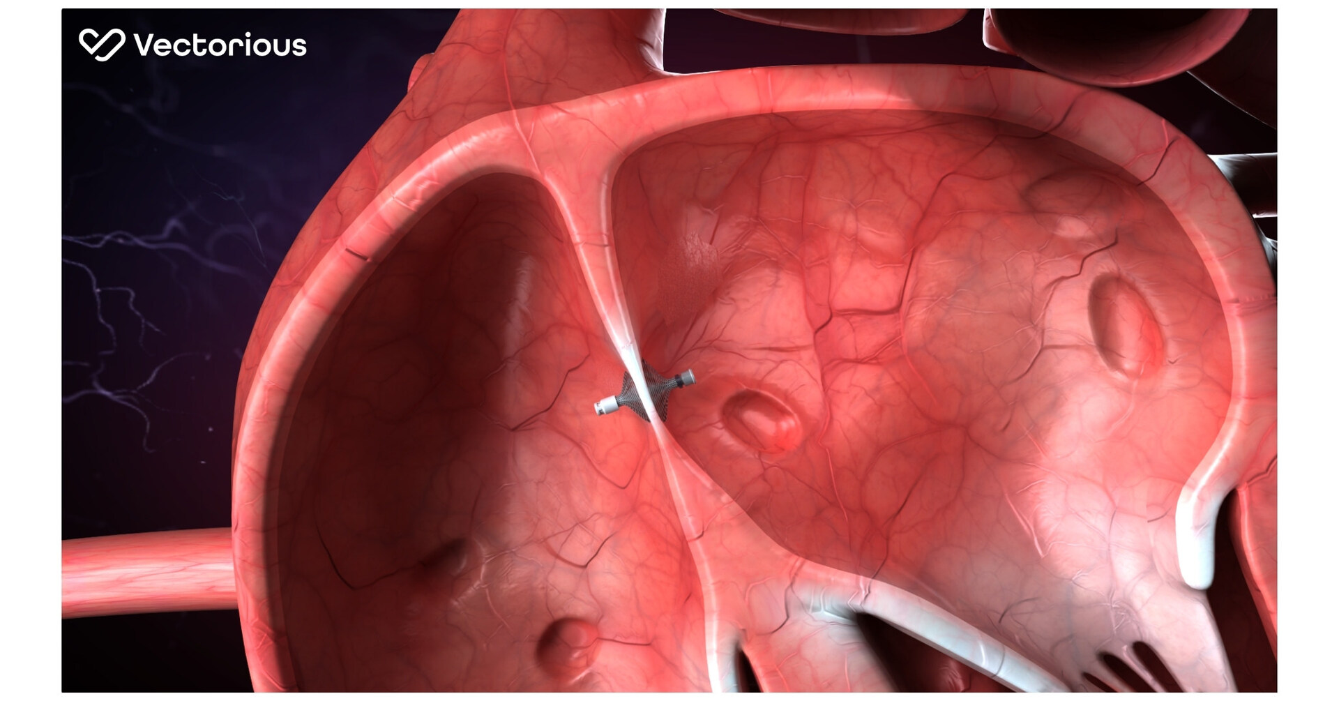 Vectorious Medical Technologies Announces First U.S. Patient Implanted ...