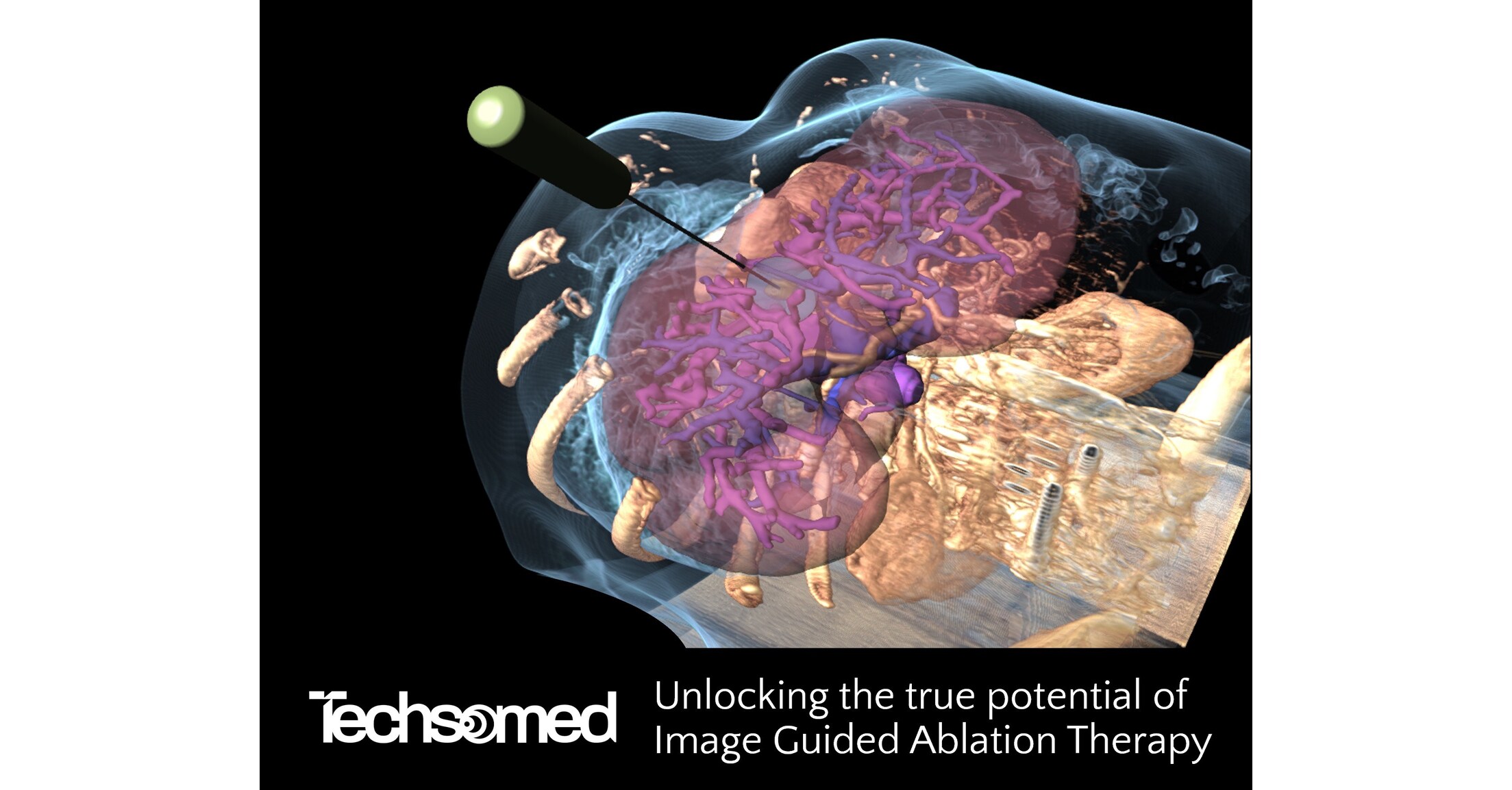 Techsomed Announces U.S. Launch of BioTraceIO Vision and BioTraceIO ...