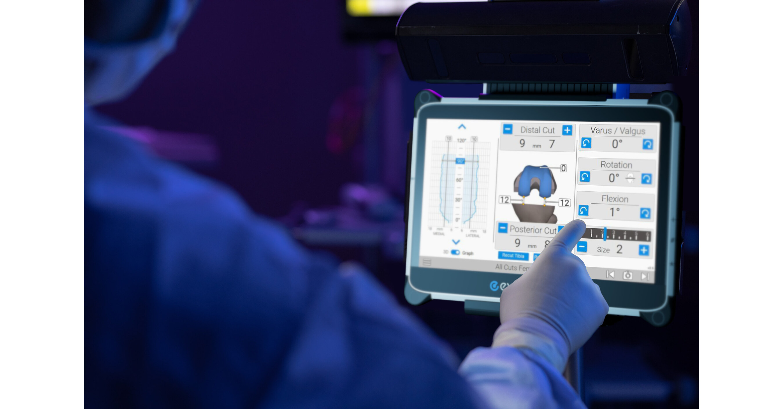 Exactech Introduces New Balancing Technology for Knee Replacement Patients