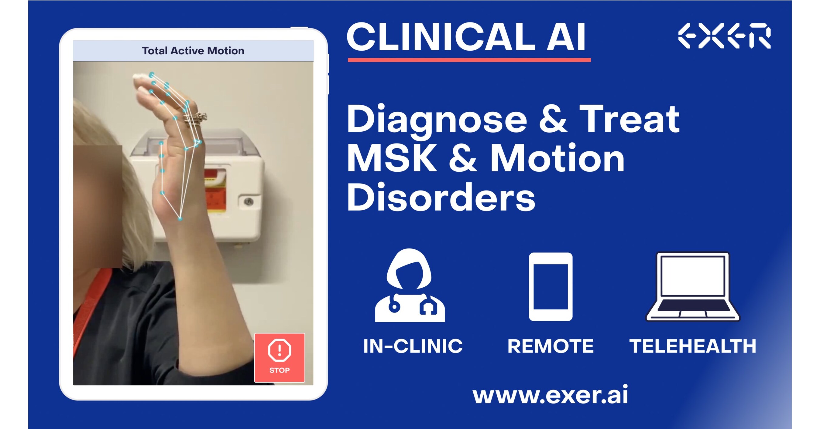 Exer AI Collaborates with Mayo Clinic to Advance Standard of Care for ...