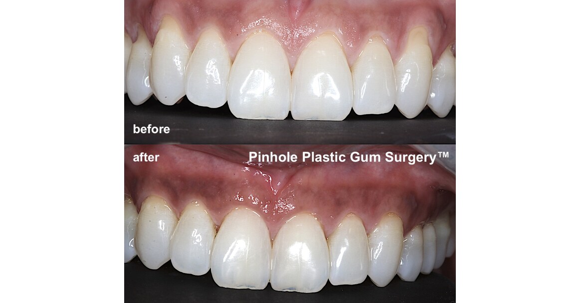 Dr. John Chao Introduces Pinhole Plastic Gum Surgery鈩?The Final Touch ...