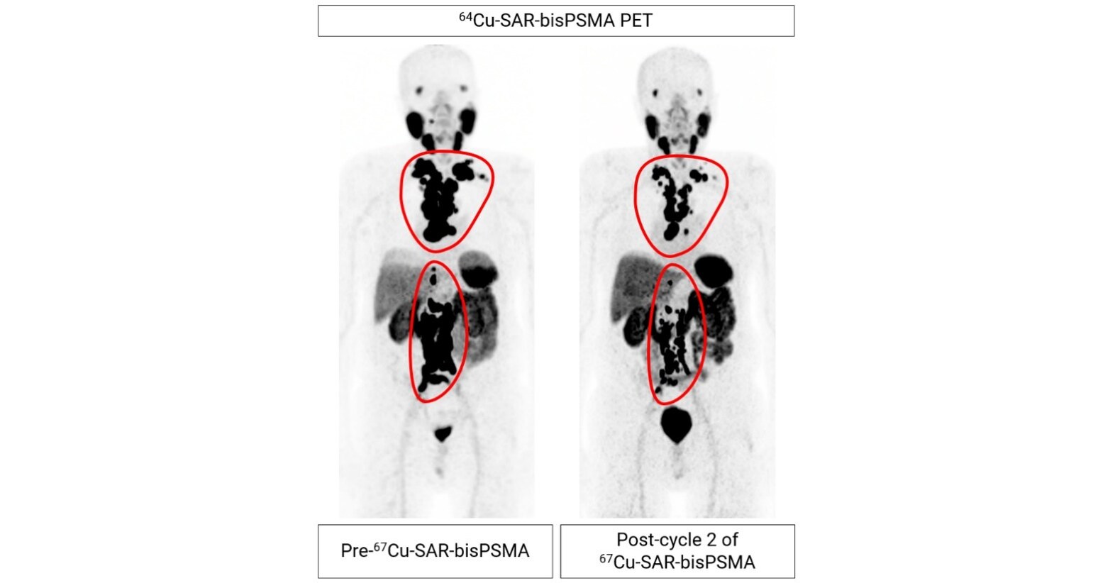 SECuRE trial advances: No dose limiting toxicities and strong ...