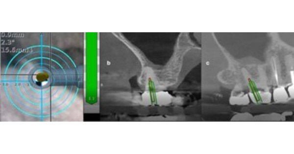 Navident EVO receives FDA Clearance for Guided Endodontics