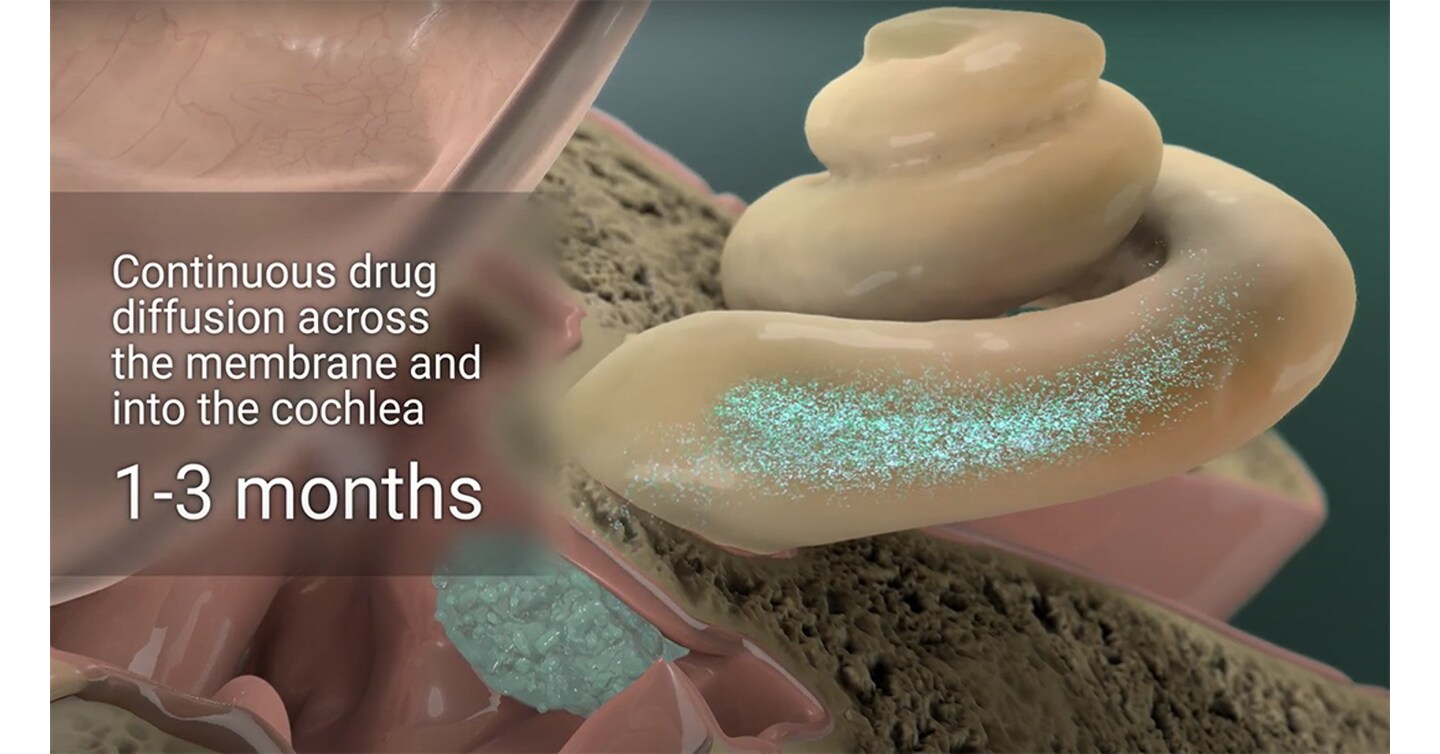 Spiral Therapeutics Announces Successful Completion of the SPT-2101 ...