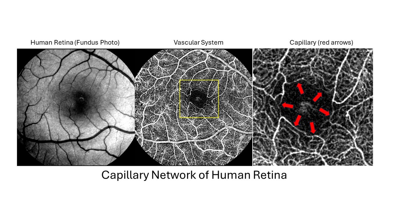 NIH Award Supports Cerebral Small Vessel Disease Detection Through the Eye