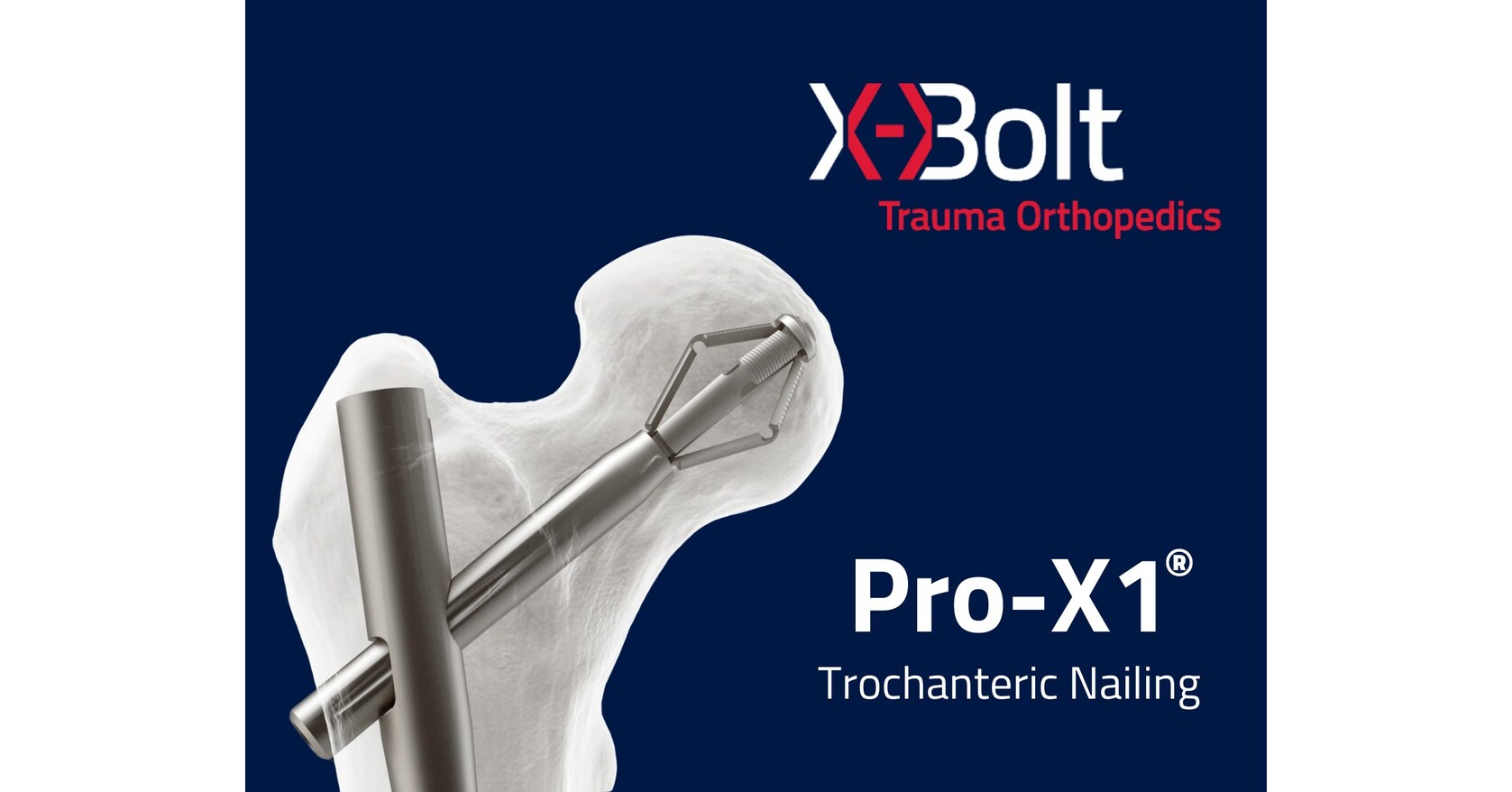 X-Bolt Announces First U.S. Implant of Pro-X1® Trochanteric Nailing System
