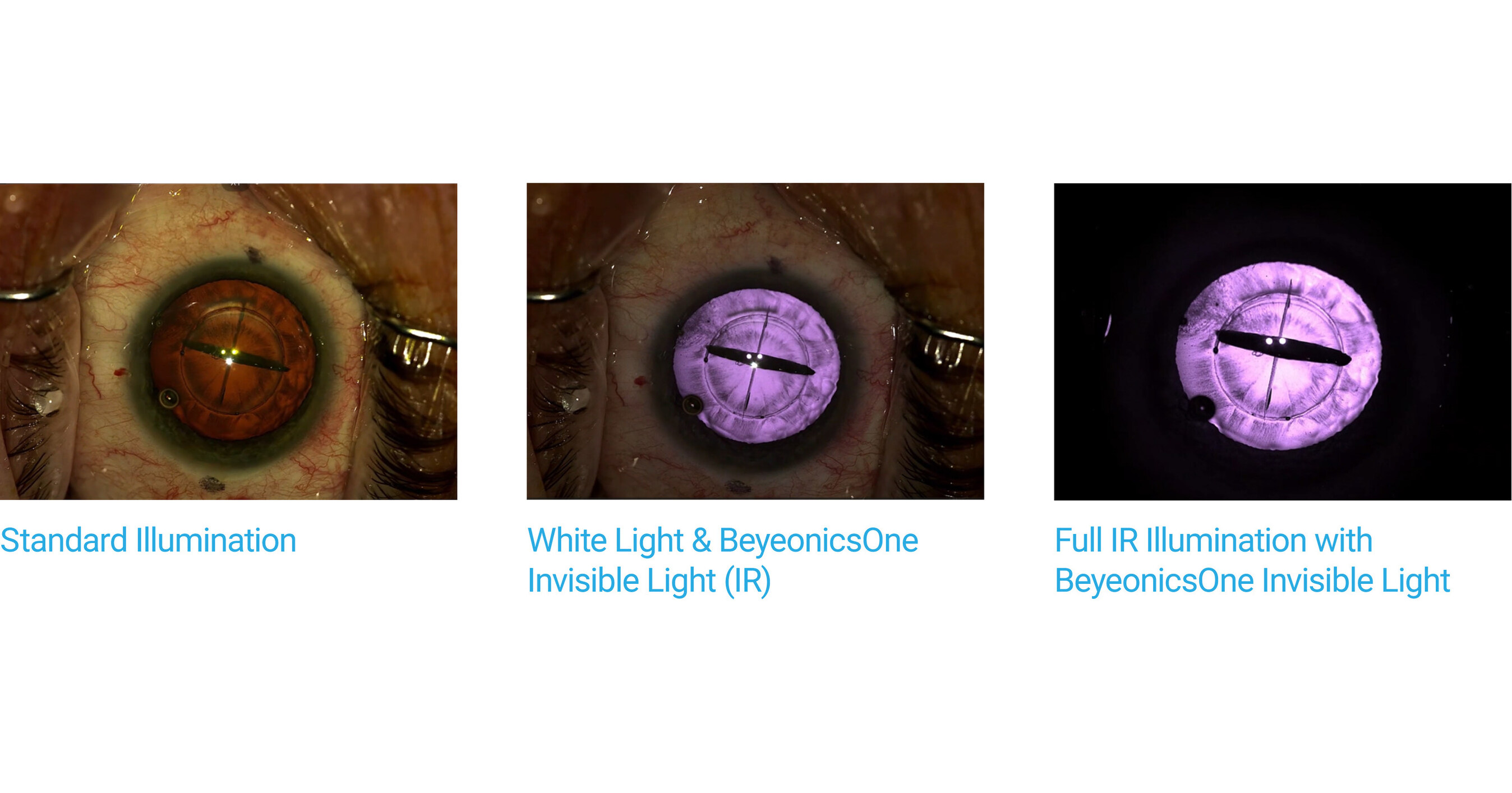 Beyeonics One Revolutionizes Ophthalmic Surgery with Invisible Light ...