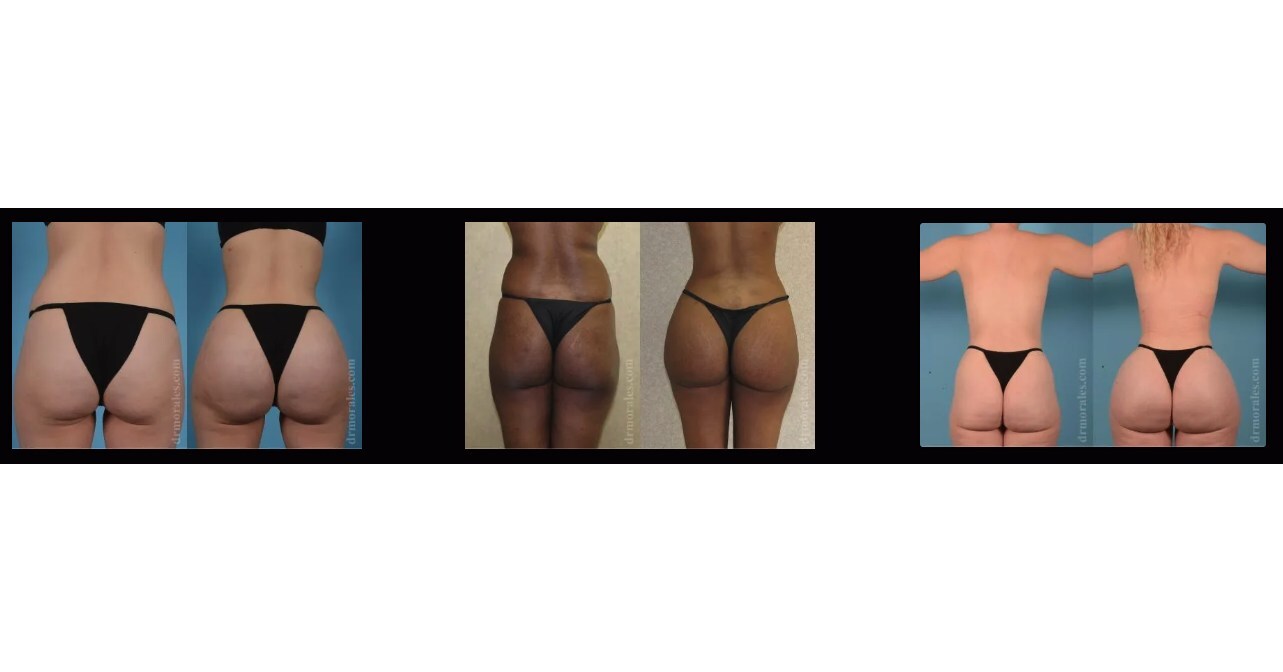 Morales Plastic Surgery Launches Revolutionary Corset Contour Procedure