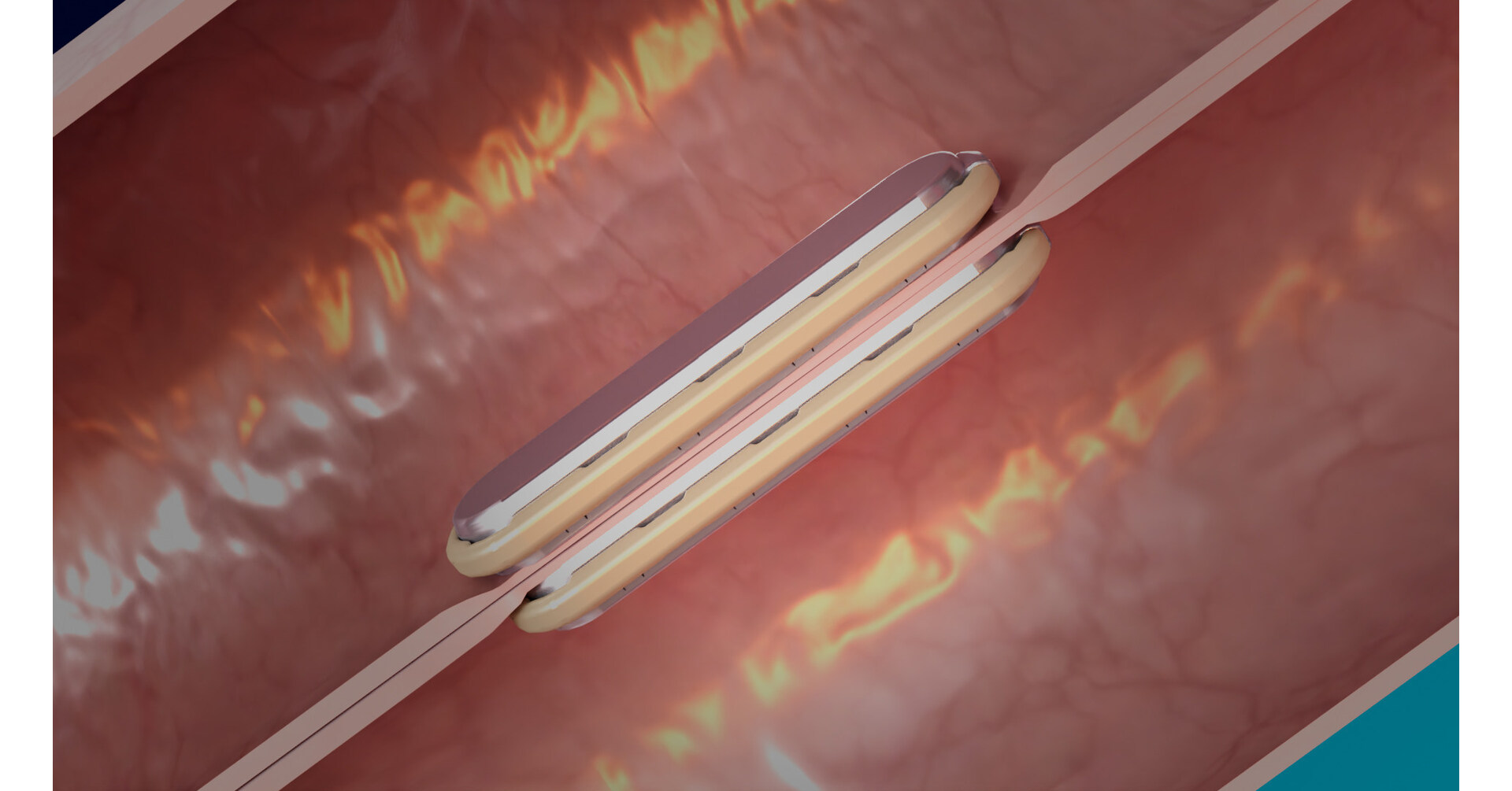 FDA clearance issued for revolutionary magnetic compression surgical ...