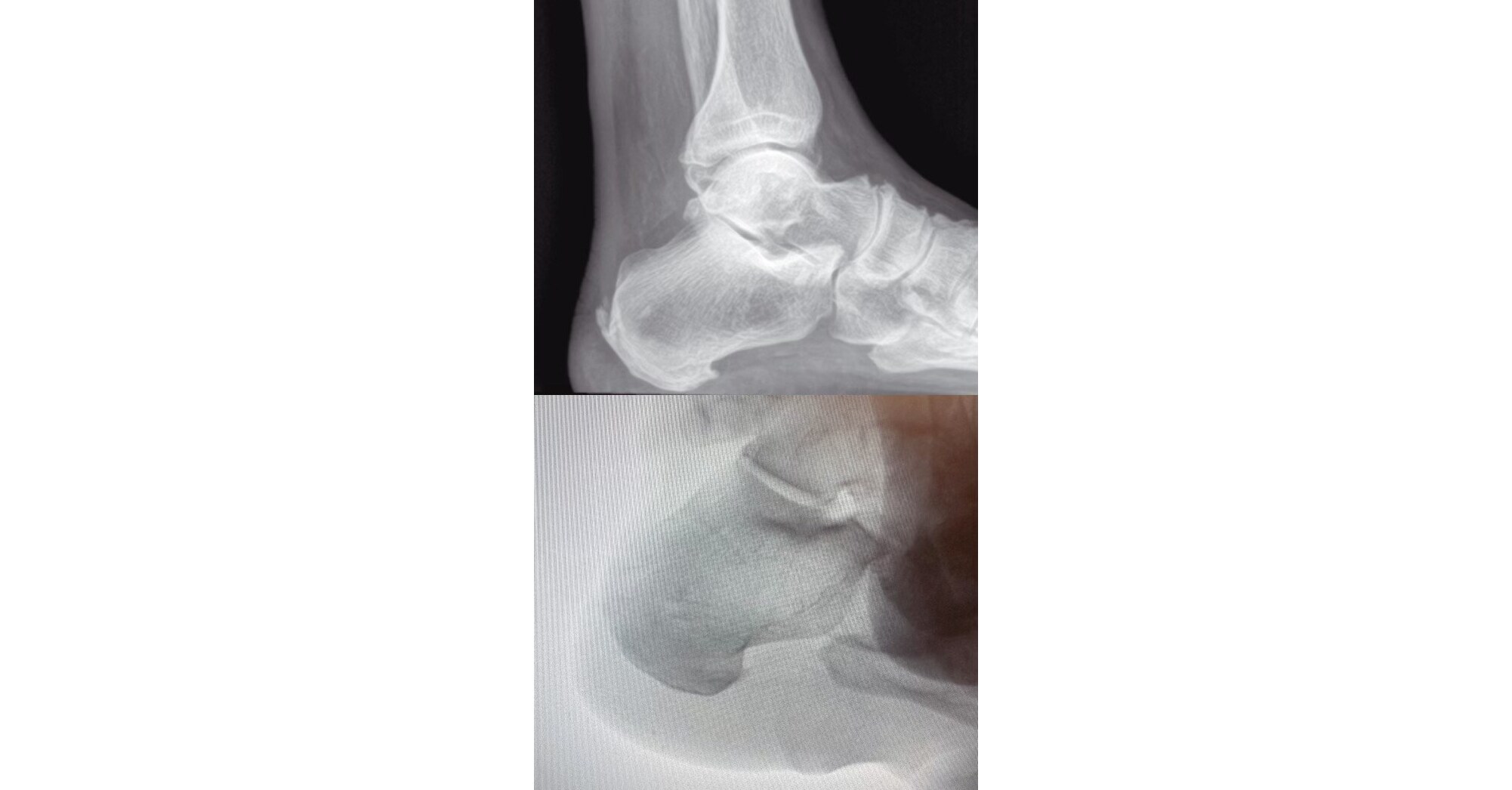 NEWPORT NEWS FOOT & ANKLE SURGEON PERFORMS FIRST MINIMALLY INVASIVE ...