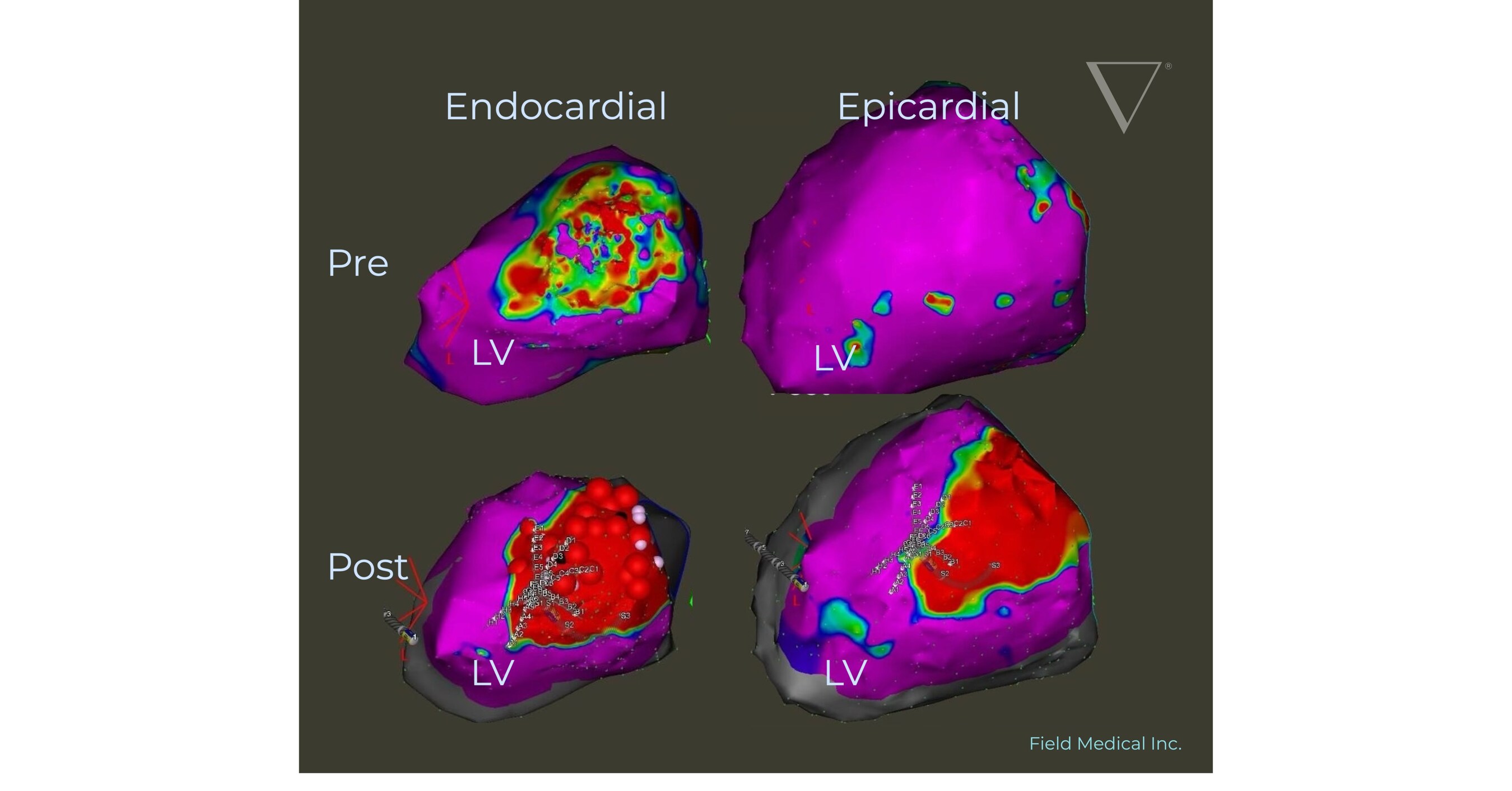 Field Medical's FieldForce™ Ablation System Earns FDA TAP Pilot ...