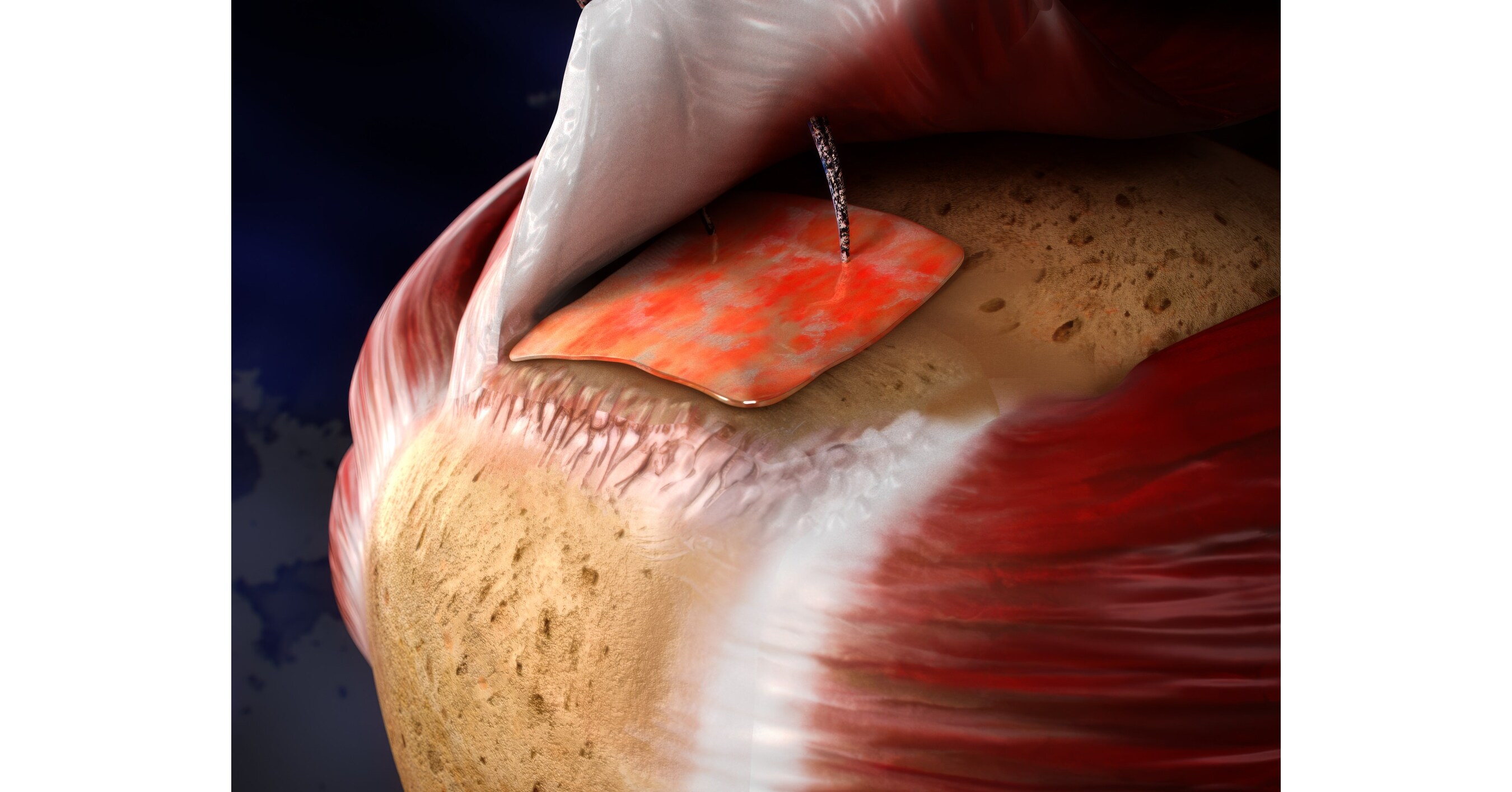 Atreon Orthopedics Surpasses 10,000 Surgeries with ROTIUM ...