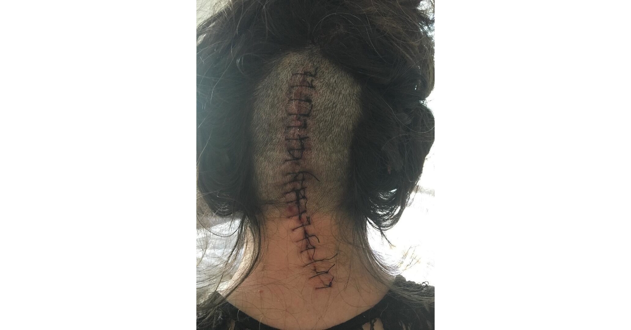 Dr. Michael T. Burcon Presenting at ARO Meniere's Disease Symposium at ...