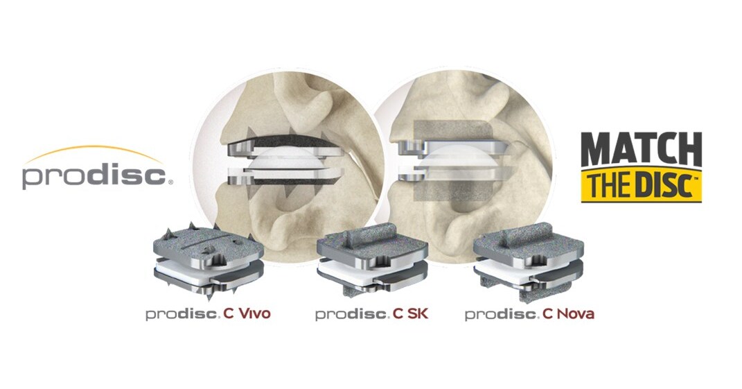 Over 10,000 Procedures Completed in U.S. with Centinel Spine's Match ...