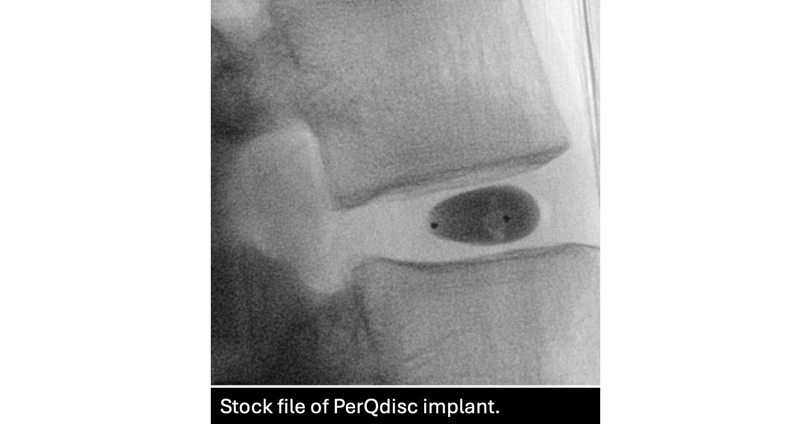 Spinal Stabilization Technologies™ Announces Enrollment of First U.S. Patient in IDE Trial for ...