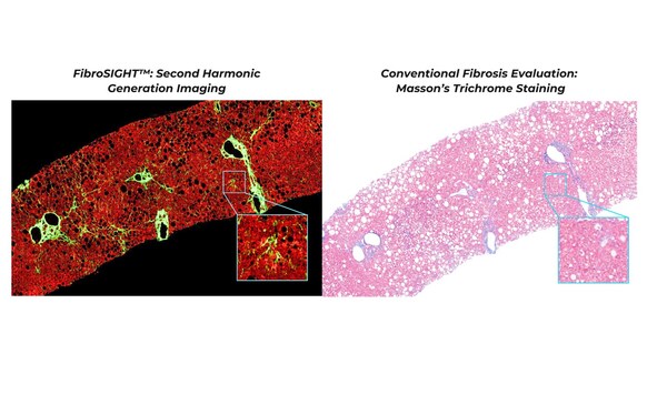 A New Standard in Clinical Care for MASH Patients: HistoIndex Launches ...
