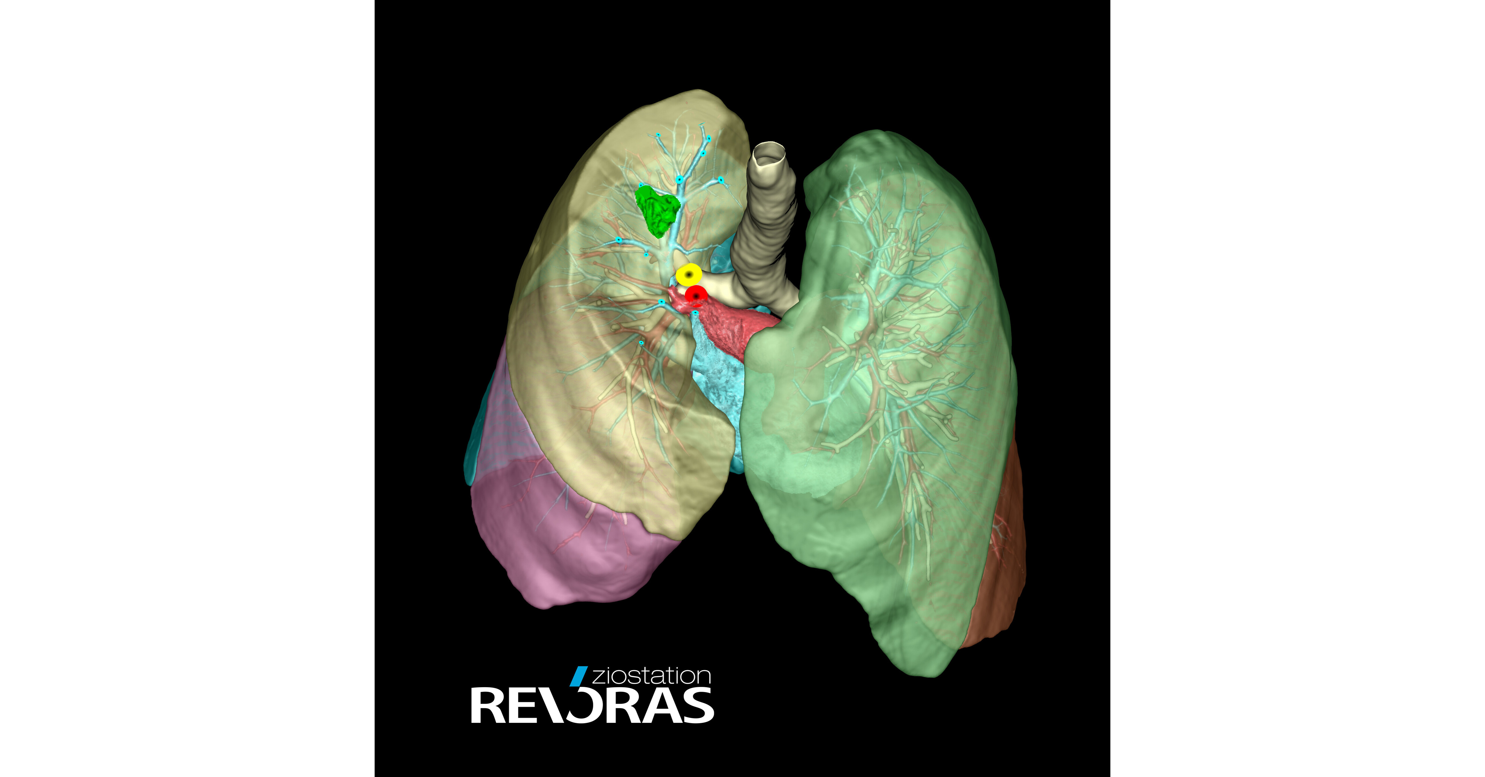 Olympus Announces Launch of AI-Powered Surgical Planning Tool Through ...