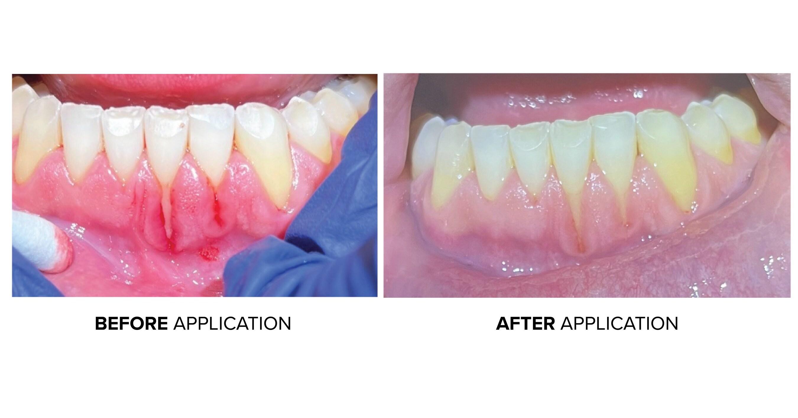 Introducing Young® ClearDefense™ Silver Fluoride - a Breakthrough in ...