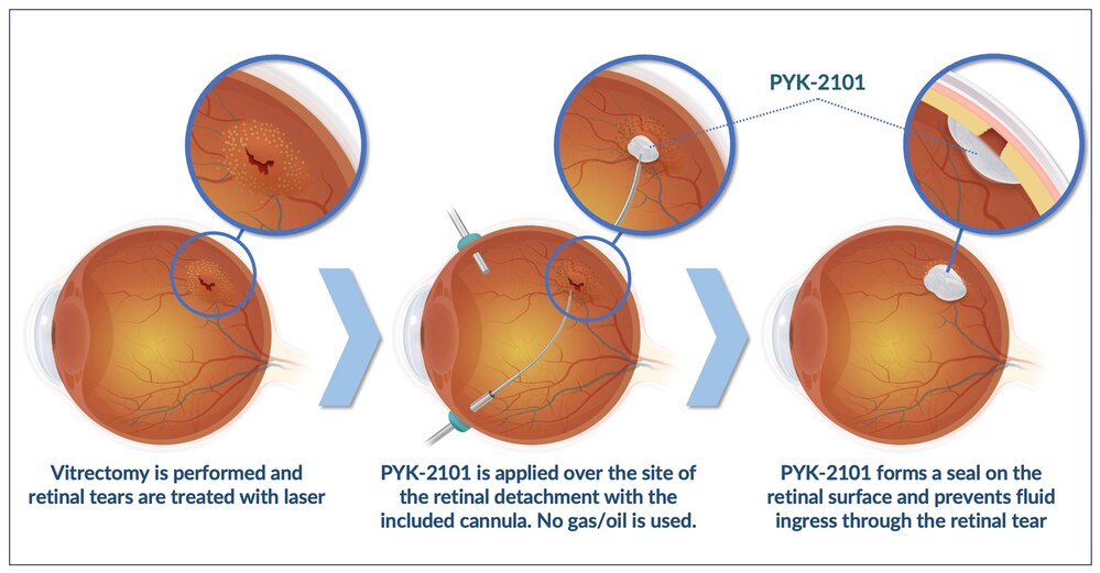 Pykus Therapeutics Completes Trial Enrollment for PYK-2101, a Novel ...