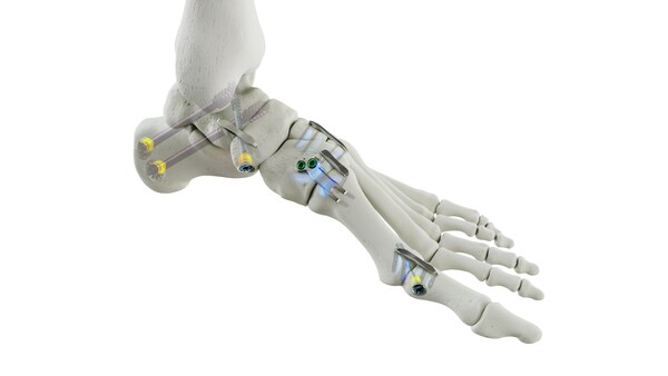 Medline announces FDA clearance for REFLEX® HYBRID Nitinol Implants for ...