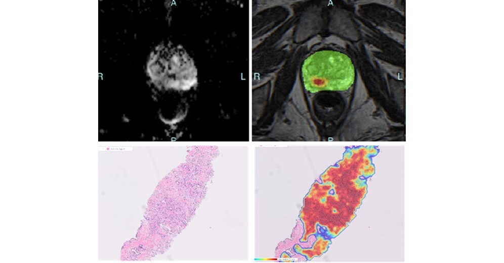 Bot Image prostate AI leads the battle against prostate cancer: Lessons ...