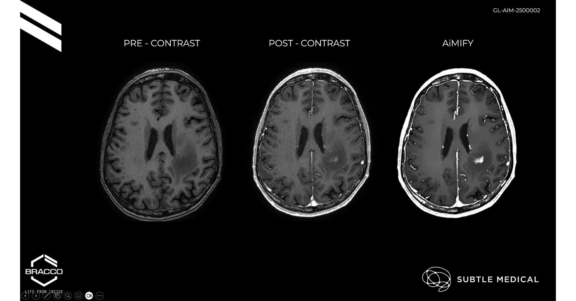 Bracco Imaging and Subtle Medical Announce CE Mark of AiMIFY™ Software ...