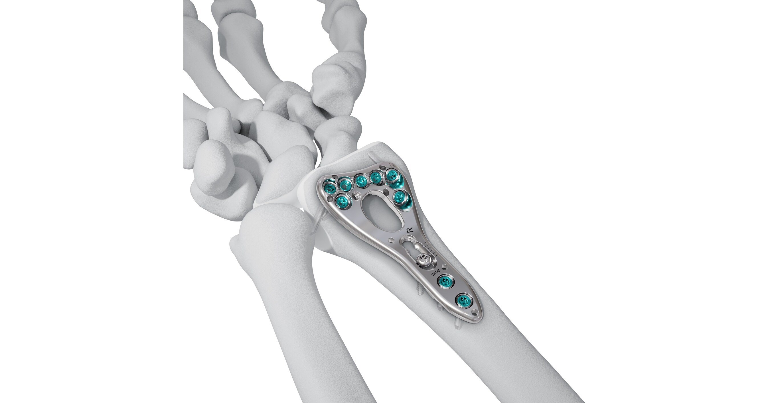 Johnson & Johnson Launches VOLT™ Wrist and Proximal Humerus Plating ...