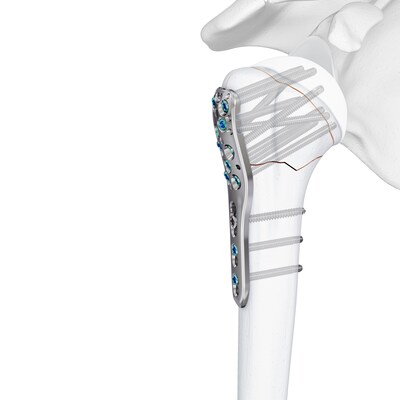 Johnson & Johnson Launches VOLT™ Wrist and Proximal Humerus Plating ...
