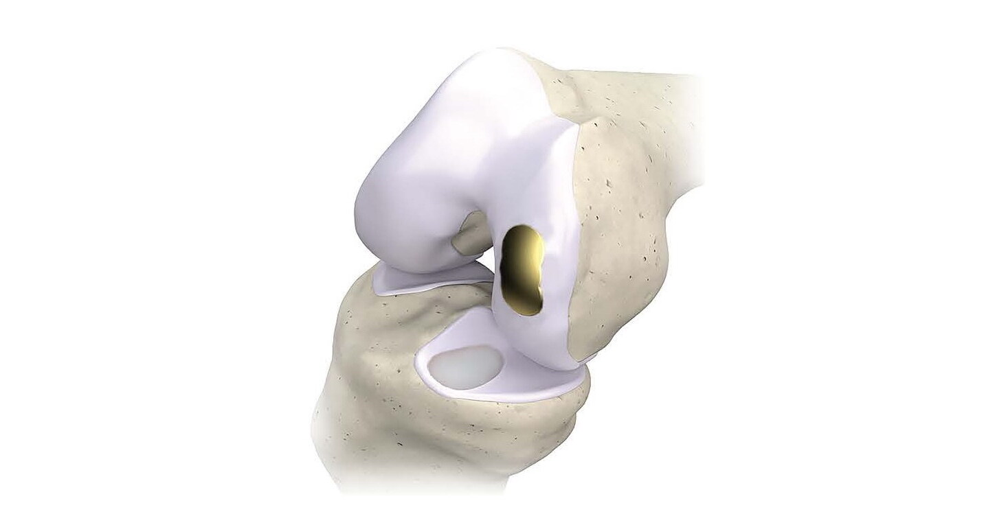 Overture Orthopaedics Announces Full Commercial Launch of the ...