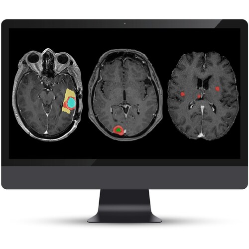 Cortechs.ai Announce Next-Gen NeuroQuant® Brain Tumor: AI-Driven ...