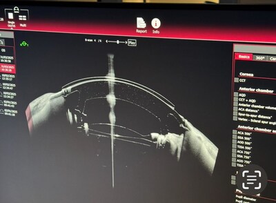 CorNeat Vision's Artificial Cornea Restores Perfect 20/20 Vision in ...