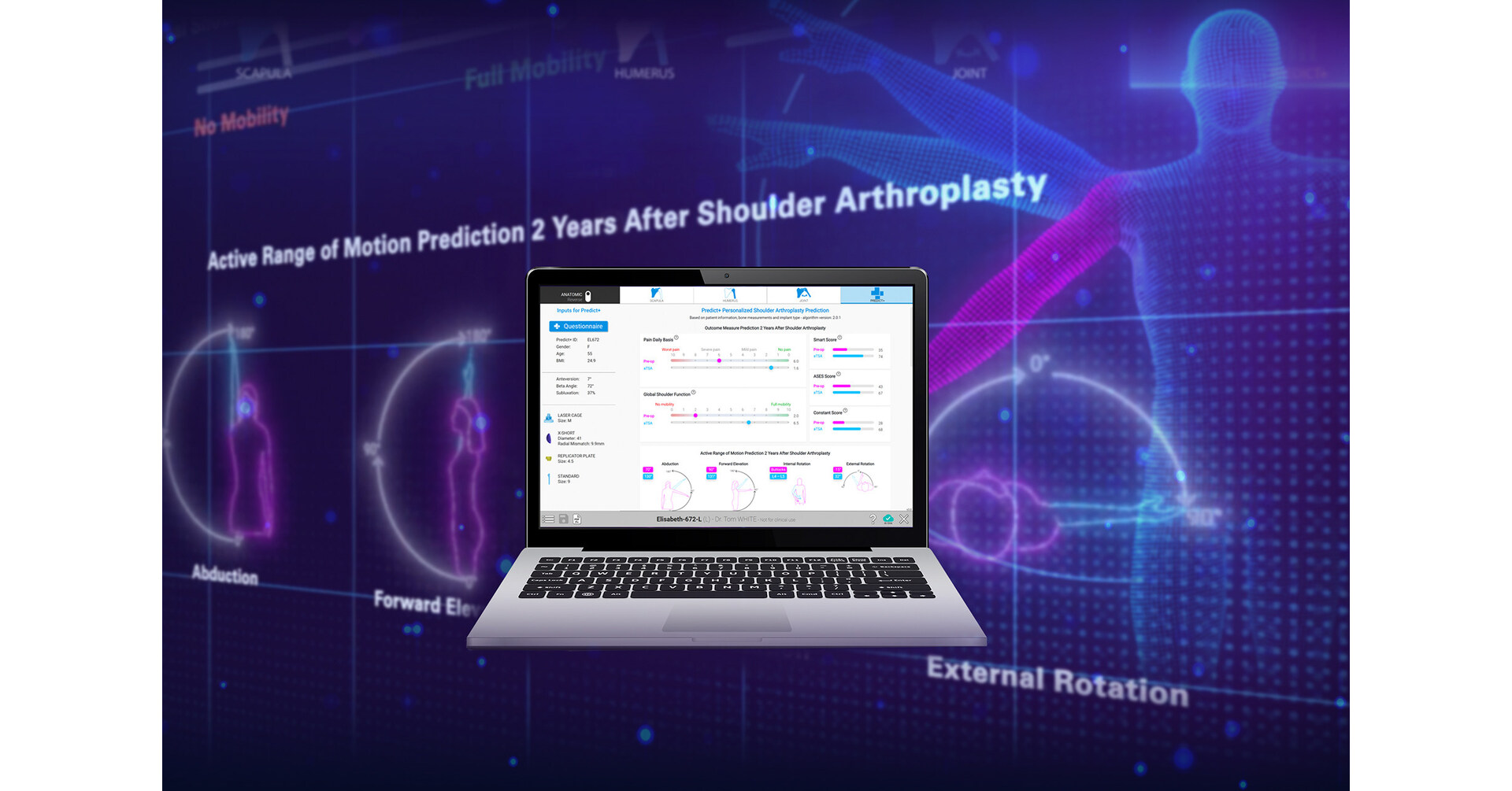Exactech Unveils First Large-Scale CT Radiomic Analysis of Shoulder Bones and Muscles ...