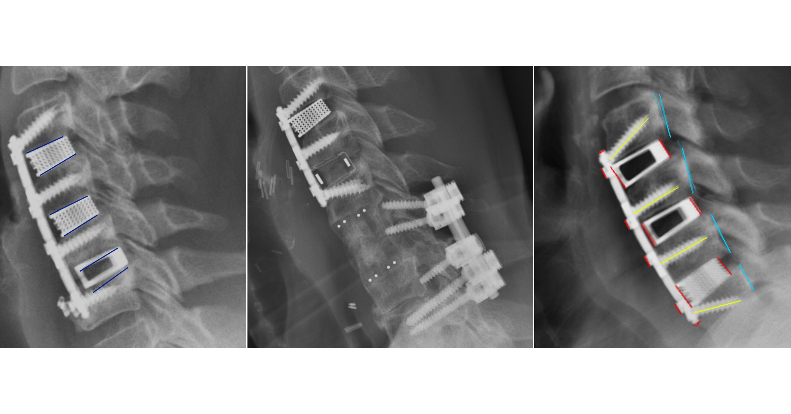 Nexus Spine's Patented Tranquil® Interbody Implants Achieve Exceptional ...