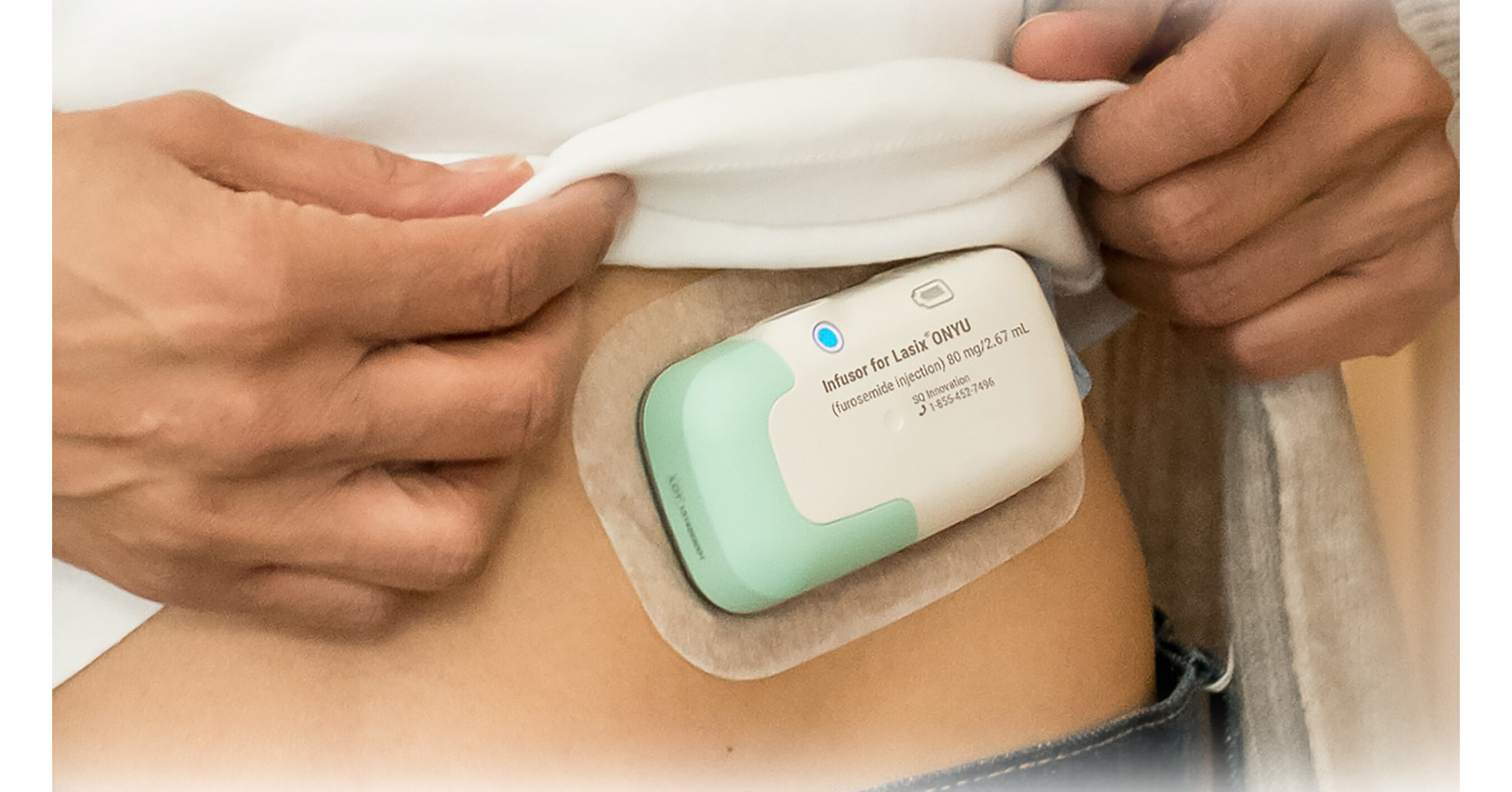 SQ Innovation Announces FDA Approval of Lasix® ONYU for Treatment of ...
