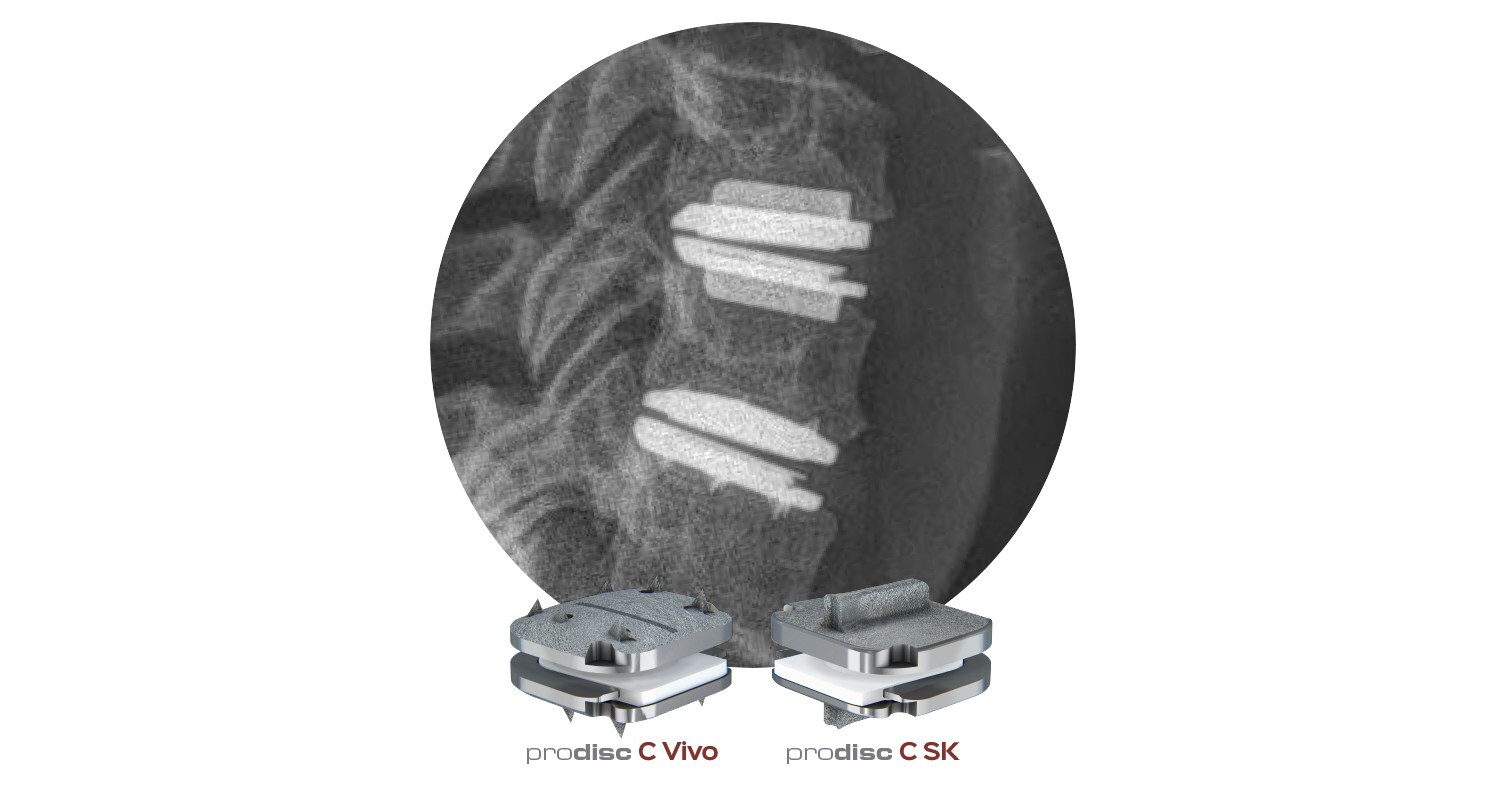 Centinel Spine® Receives Two-Level FDA Approval for prodisc® C Vivo and ...