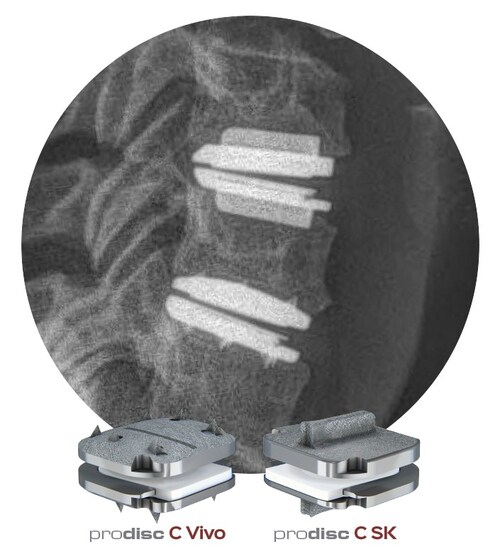 Centinel Spine® Receives Two-Level FDA Approval for prodisc® C Vivo and ...
