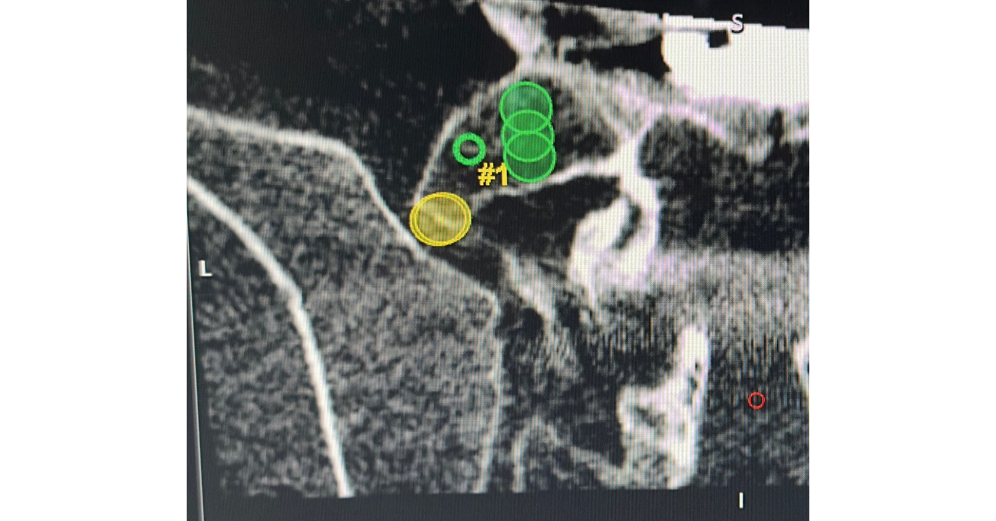 VSI® Performs World's First Robotic Minimally Invasive Bertolotti ...