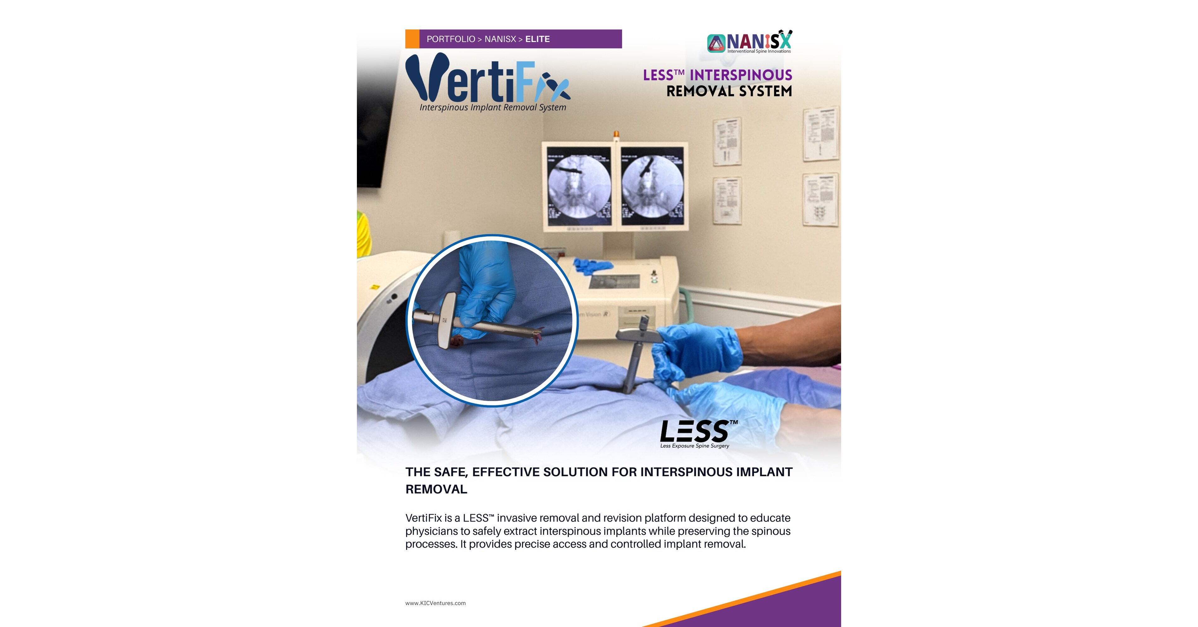 New System to Safely Remove Vertiflex Implants and Preserve the Spinous ...