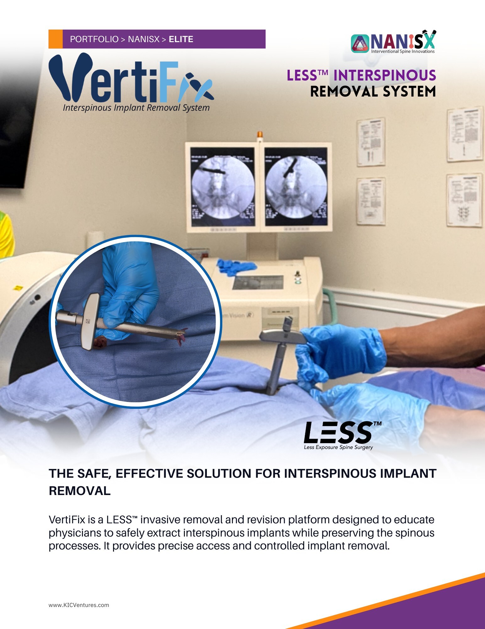 New System to Safely Remove Vertiflex Implants and Preserve the Spinous ...