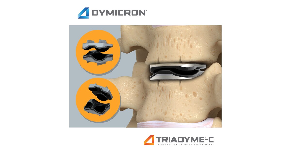 Dymicron Announces First Patient Enrolled in Triadyme-C IDE Clinical Trial