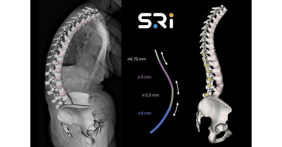 Notice of Allowability Issued for Variable-Dimension Fixation Rod and ...