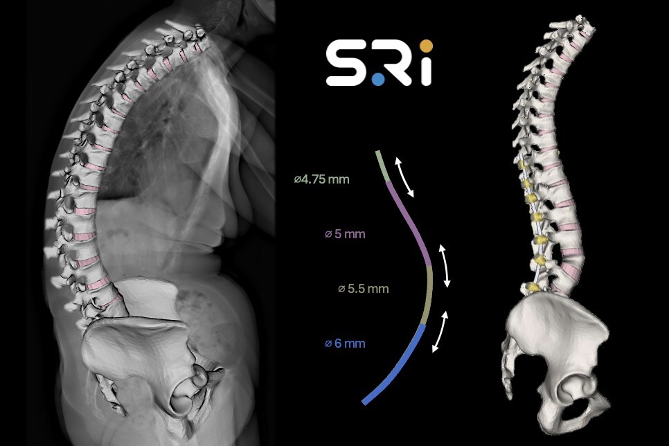 Notice of Allowability Issued for Variable-Dimension Fixation Rod and ...
