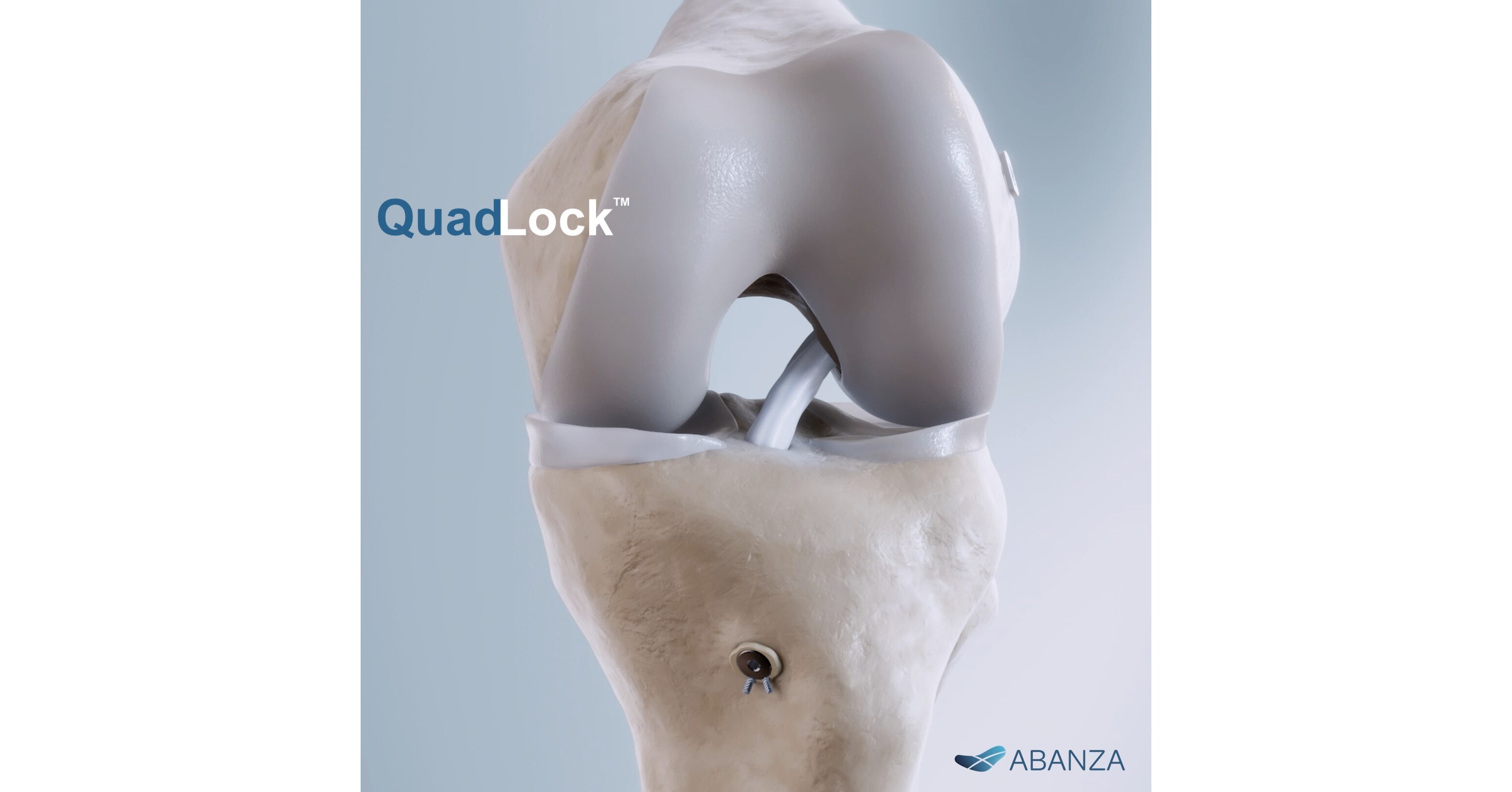ABANZA Secures FDA 510(k) Clearance for QuadLock™ Fixation System for ...