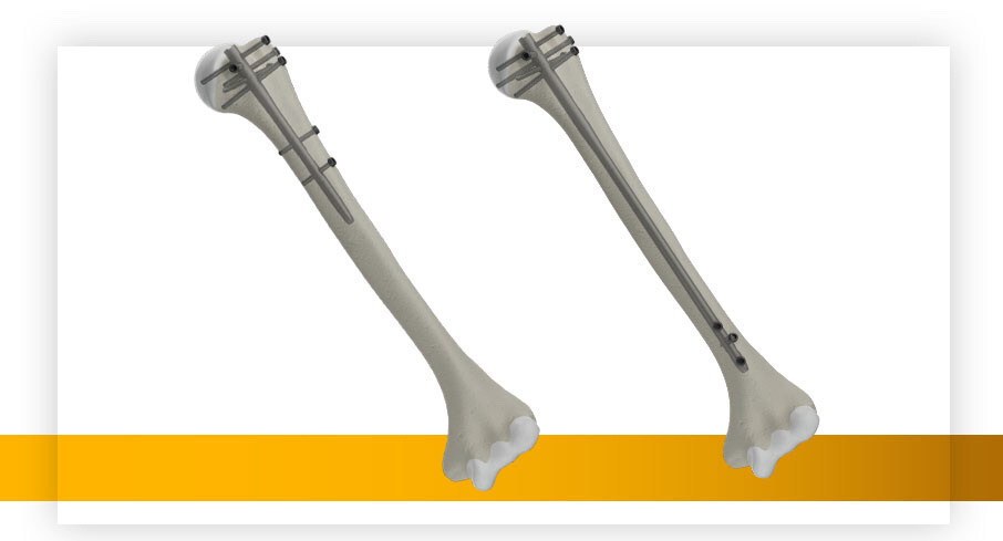 Stryker launches T2 Alpha Humerus Nailing System, supporting surgical ...