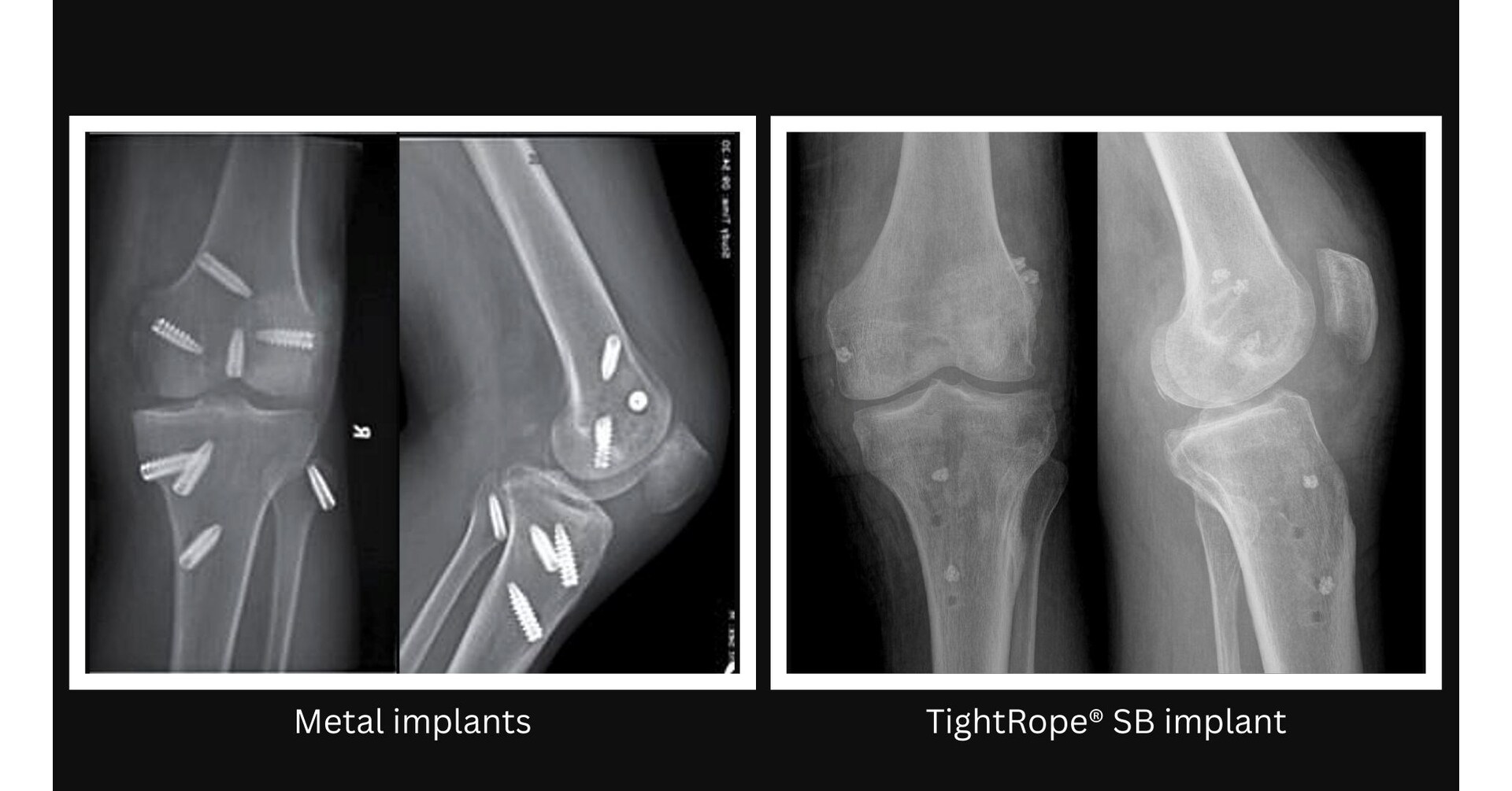 Arthrex Releases TightRope® SB All-Suture Implant for ACL Fixation