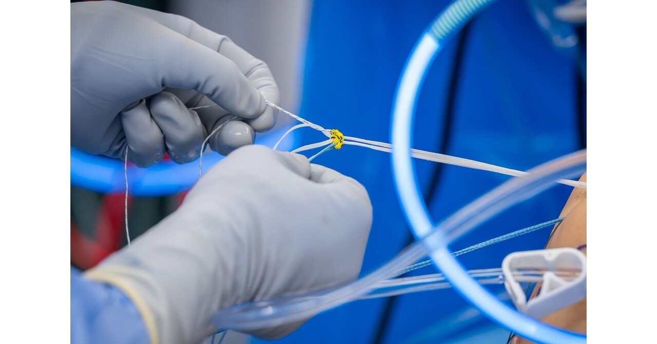 Arthrex Releases TightRope® SB All-Suture Implant for ACL Fixation
