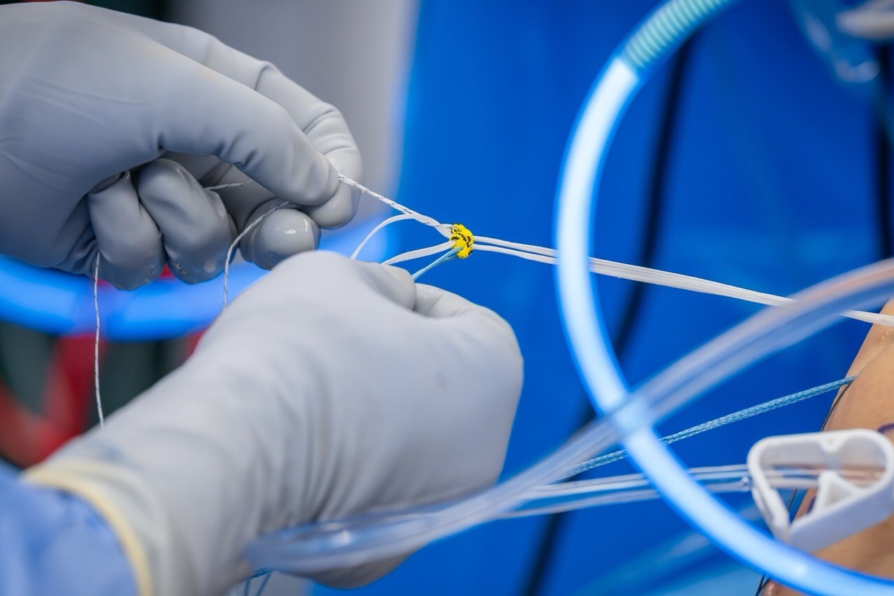 Arthrex Releases TightRope® SB All-Suture Implant for ACL Fixation ...