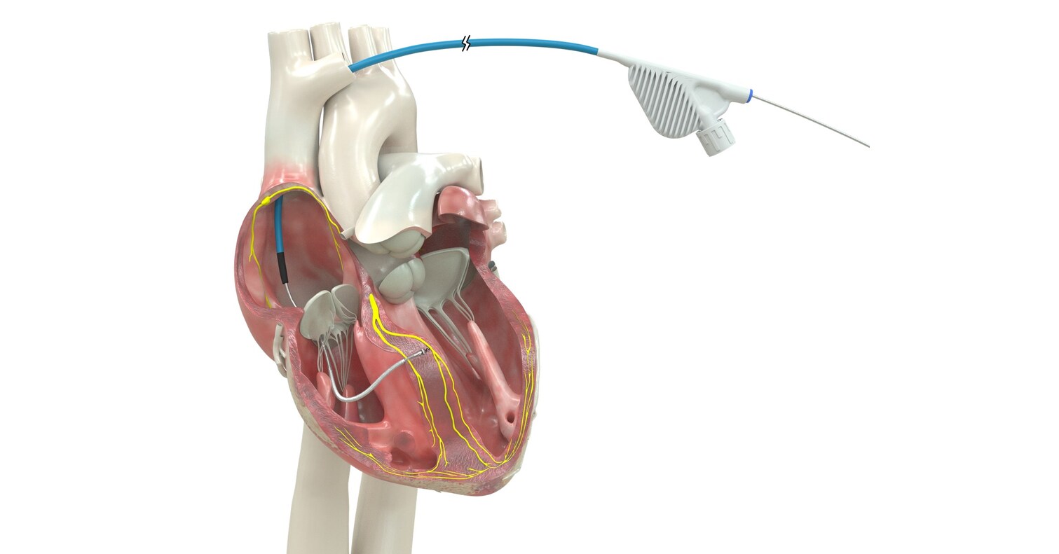 Medtronic OmniaSecure™ defibrillation lead is the first lead of its ...