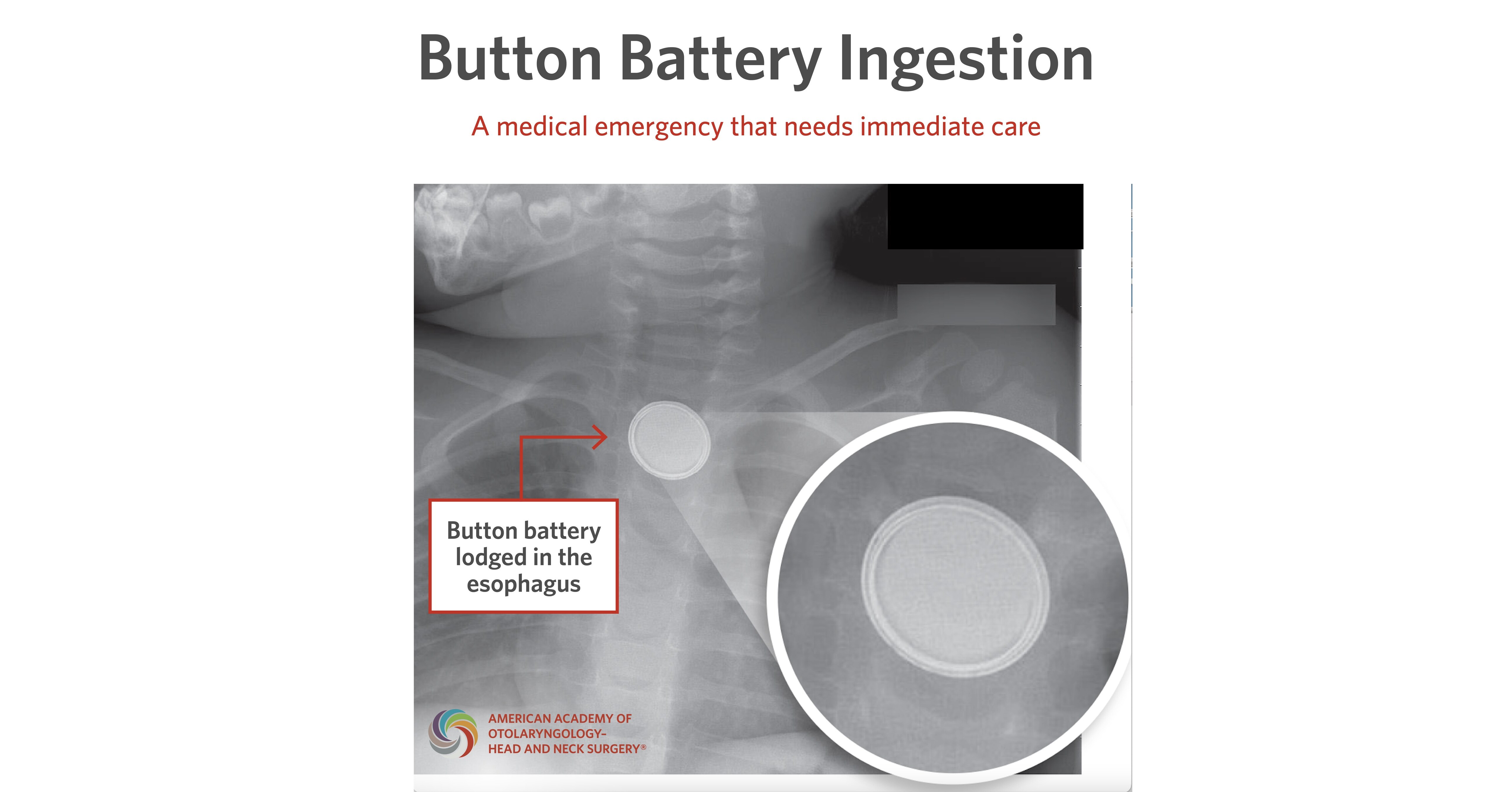 New Button Battery Technology Shows Promise, but Swallowing Remains an ...